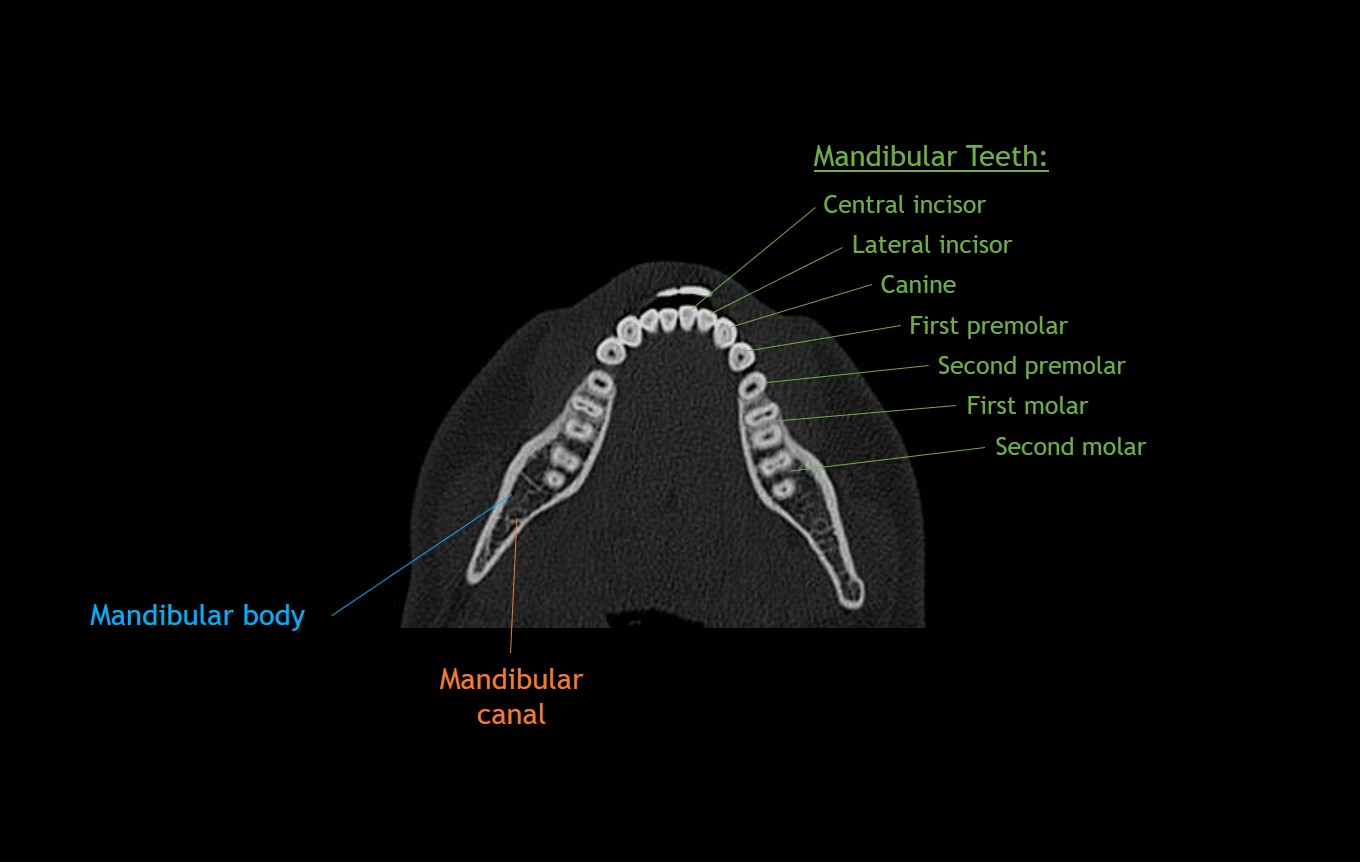 CT Axial Face Anatomy | CaseStacks.com