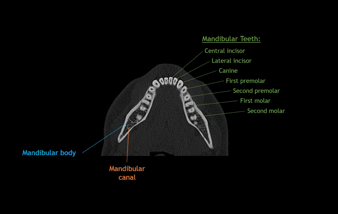 CT Axial Face Anatomy | CaseStacks.com