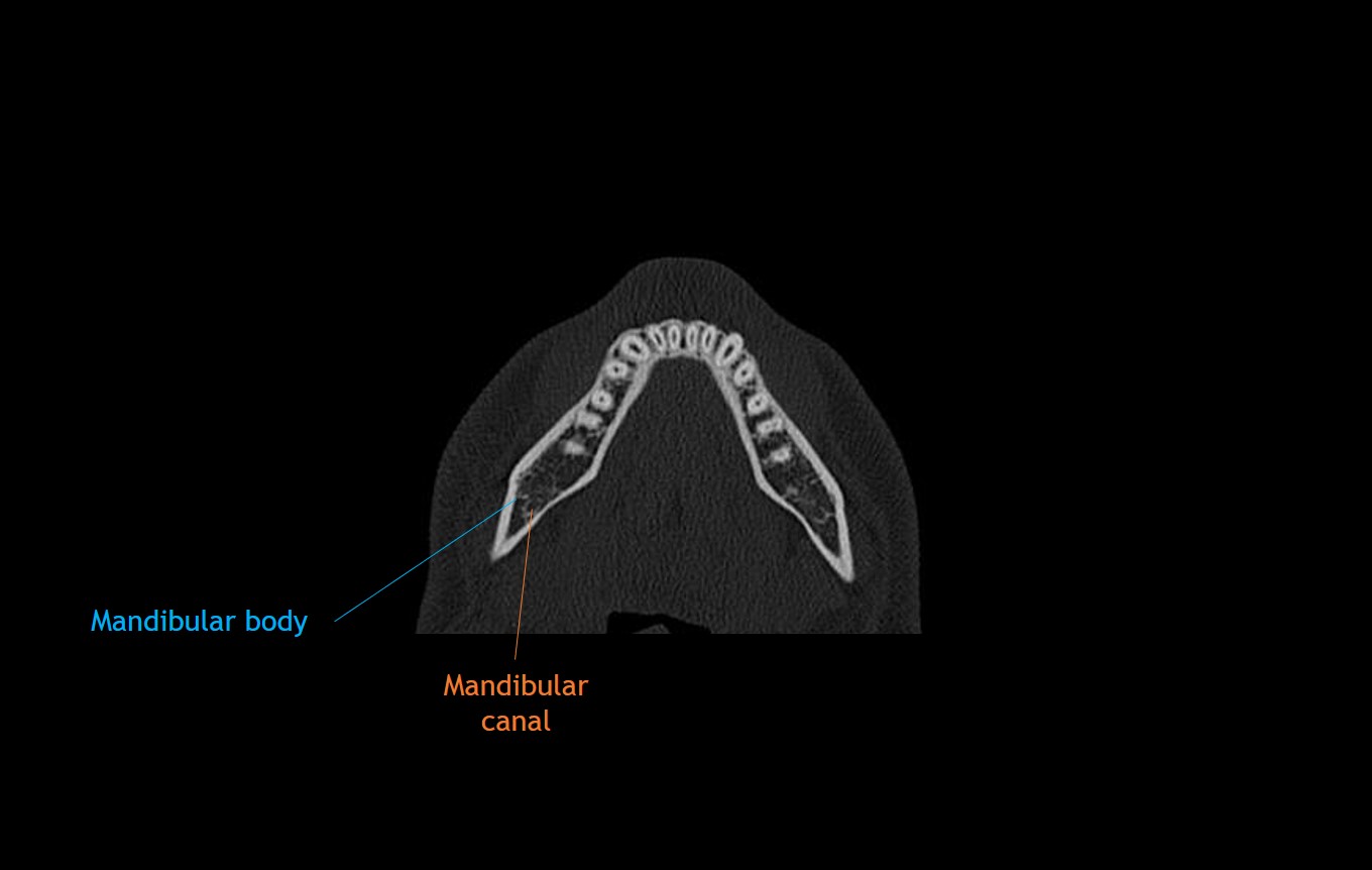 CT Axial Face Anatomy | CaseStacks.com