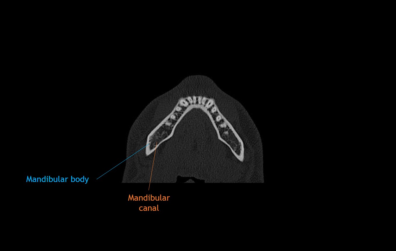CT Axial Face Anatomy | CaseStacks.com