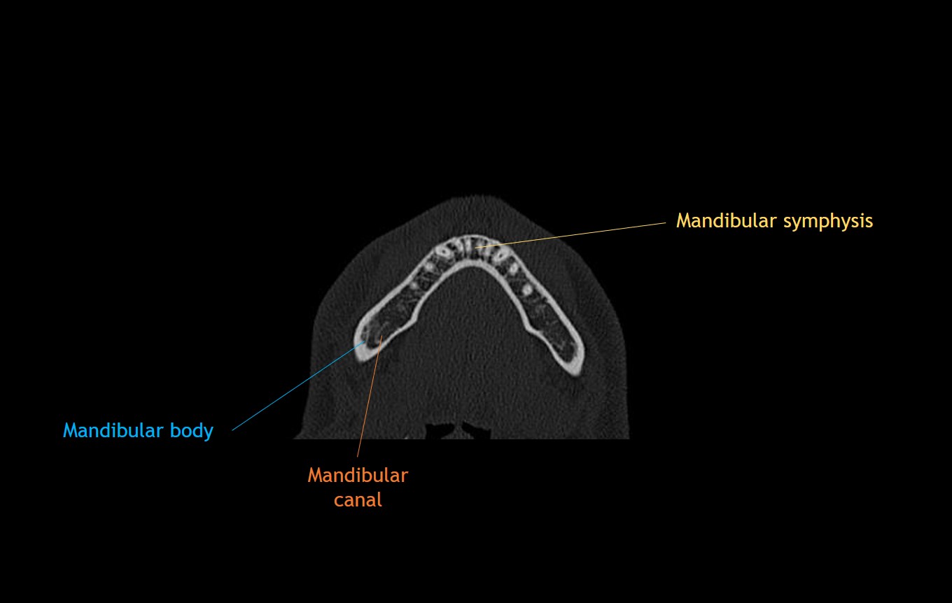 CT Axial Face Anatomy | CaseStacks.com