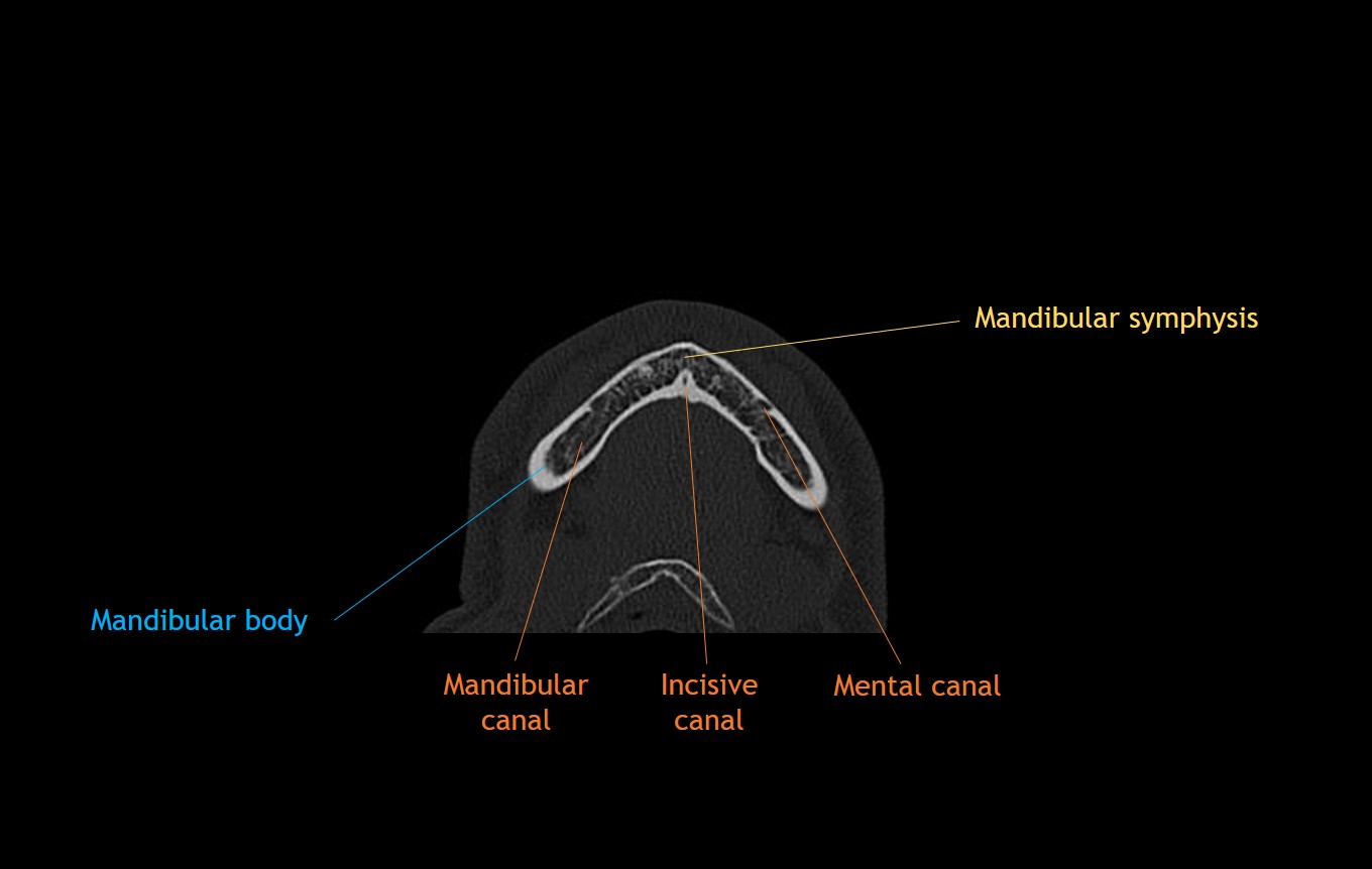 CT Axial Face Anatomy | CaseStacks.com