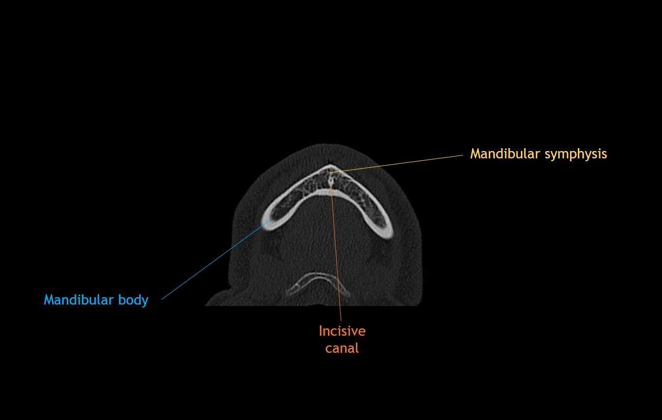 CT Axial Face Anatomy | CaseStacks.com