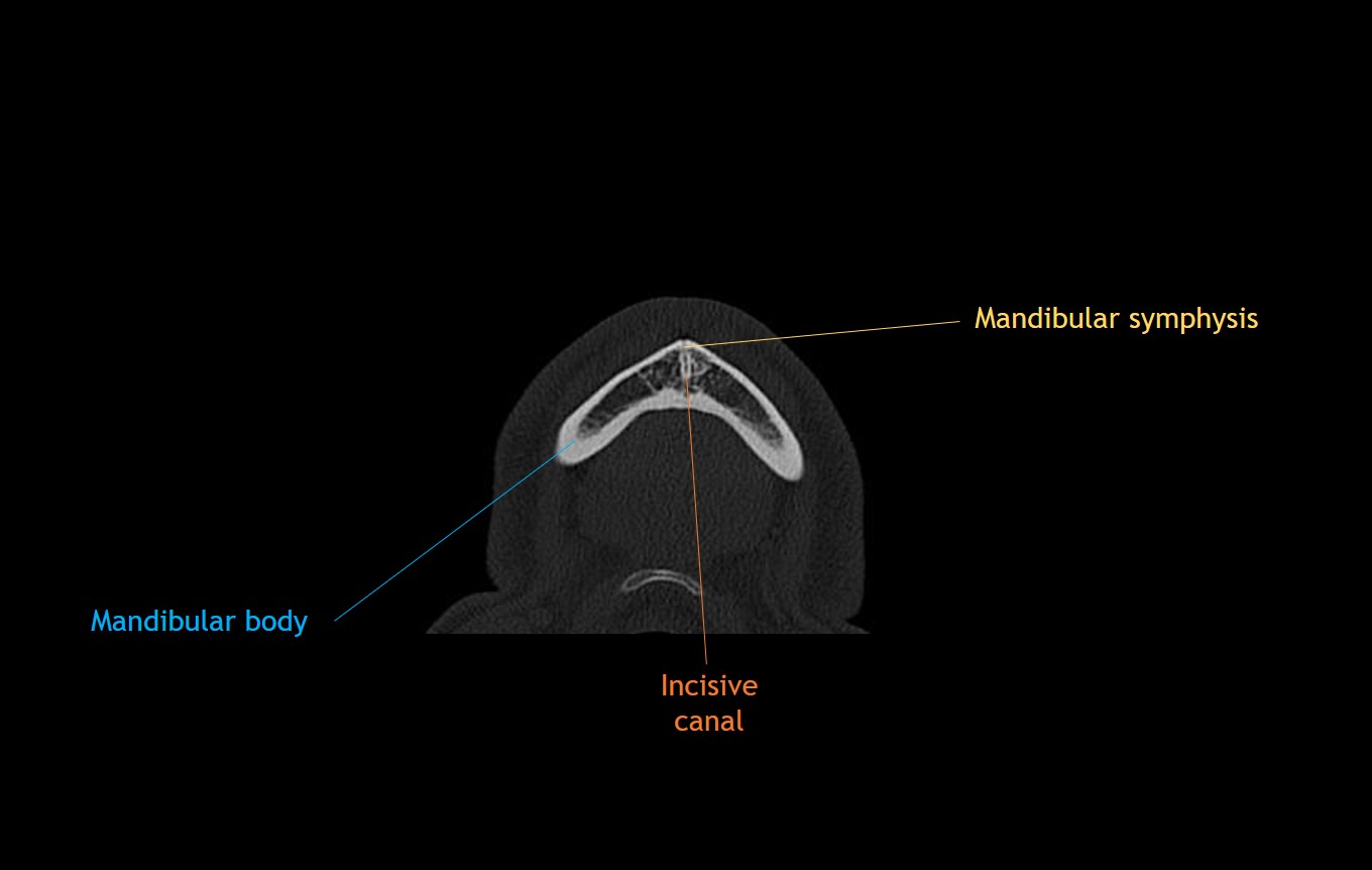 CT Axial Face Anatomy | CaseStacks.com