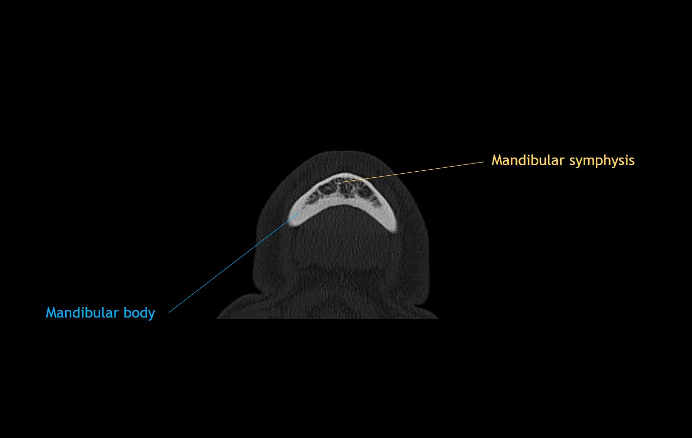 CT Axial Face Anatomy | CaseStacks.com