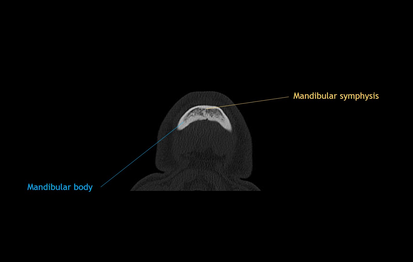 CT Axial Face Anatomy | CaseStacks.com