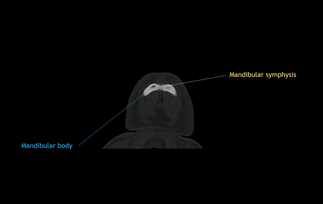 CT Axial Face Anatomy | CaseStacks.com