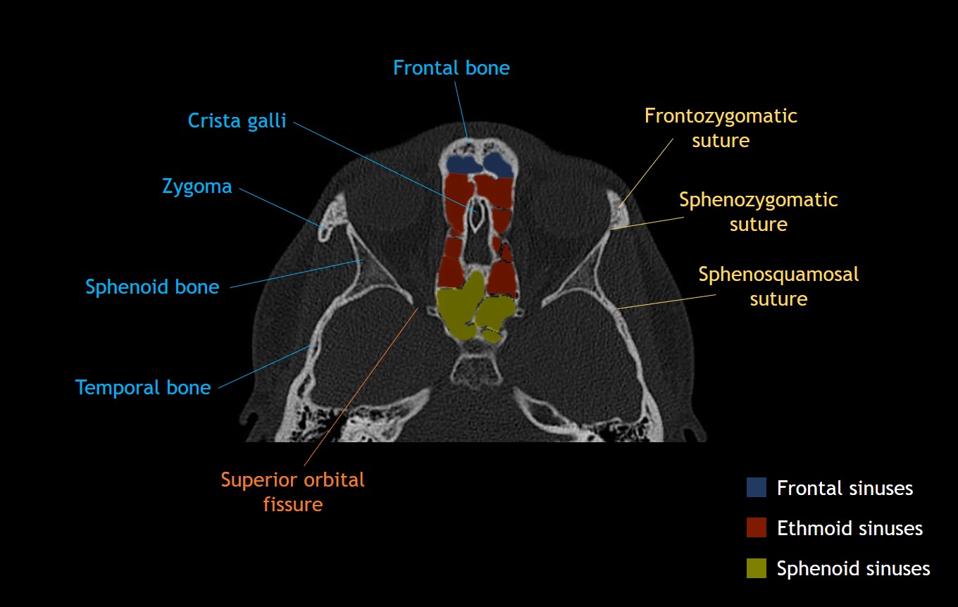 CT Axial Face Anatomy | CaseStacks.com
