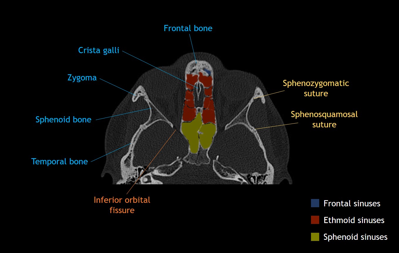 CT Axial Face Anatomy | CaseStacks.com