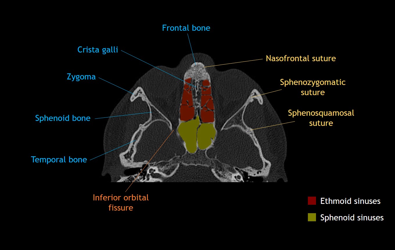 Axial Ct Anatomy Head And Spine Anatomy Radiology Cafe