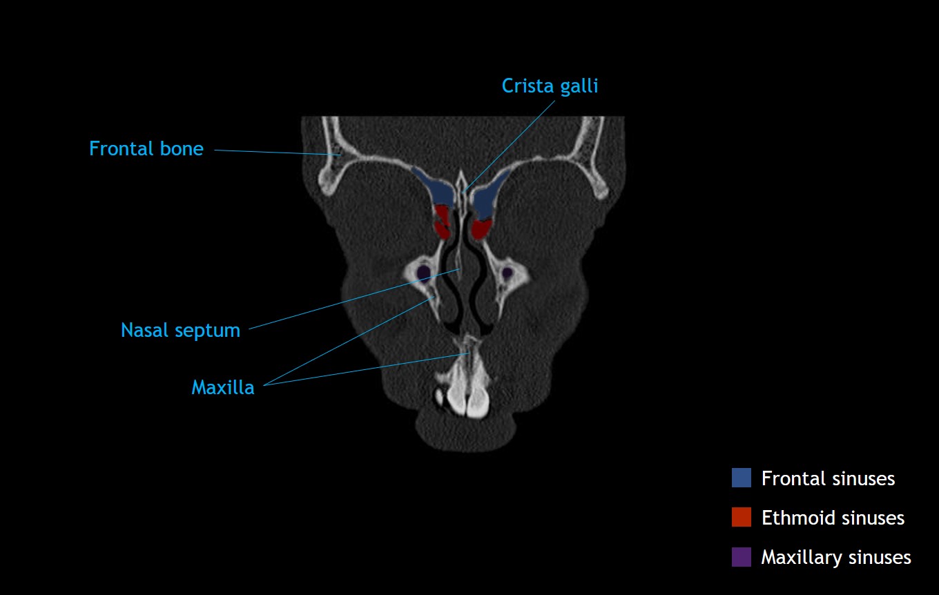 Coronal Face CT Anatomy | CaseStacks.com