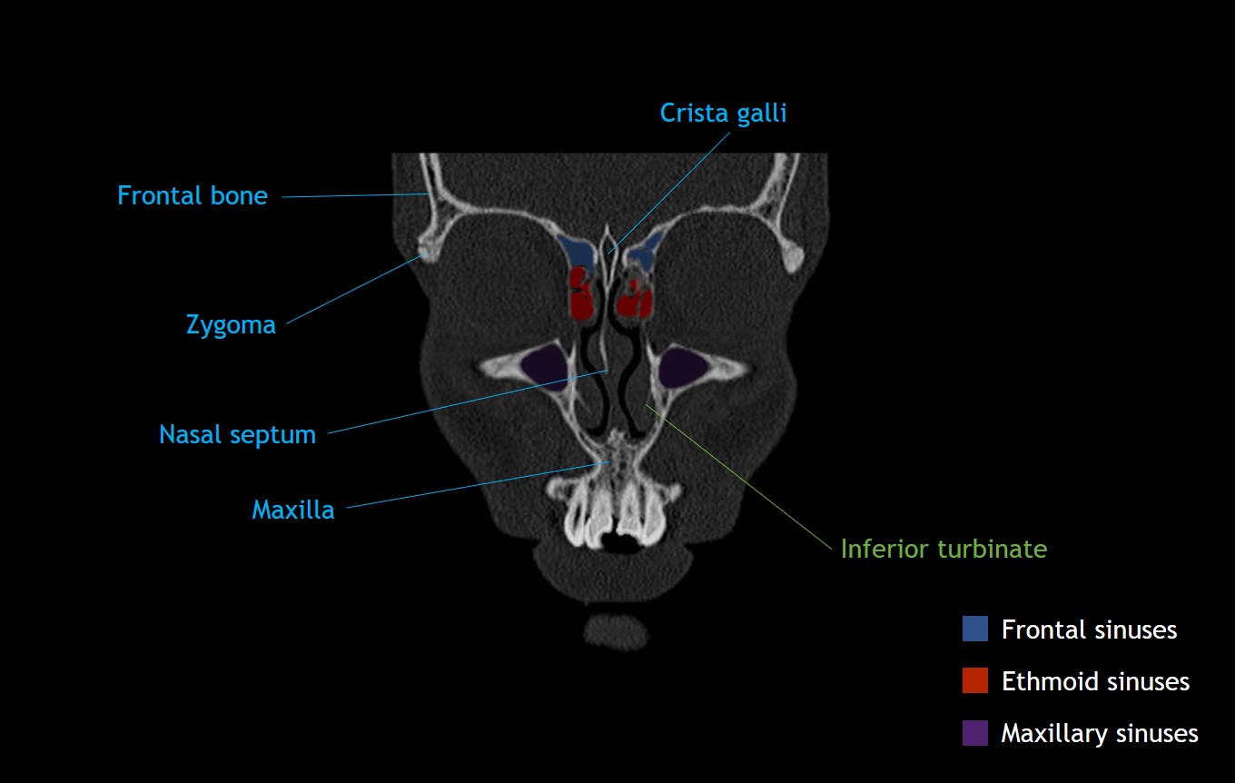 Coronal Face CT Anatomy | CaseStacks.com