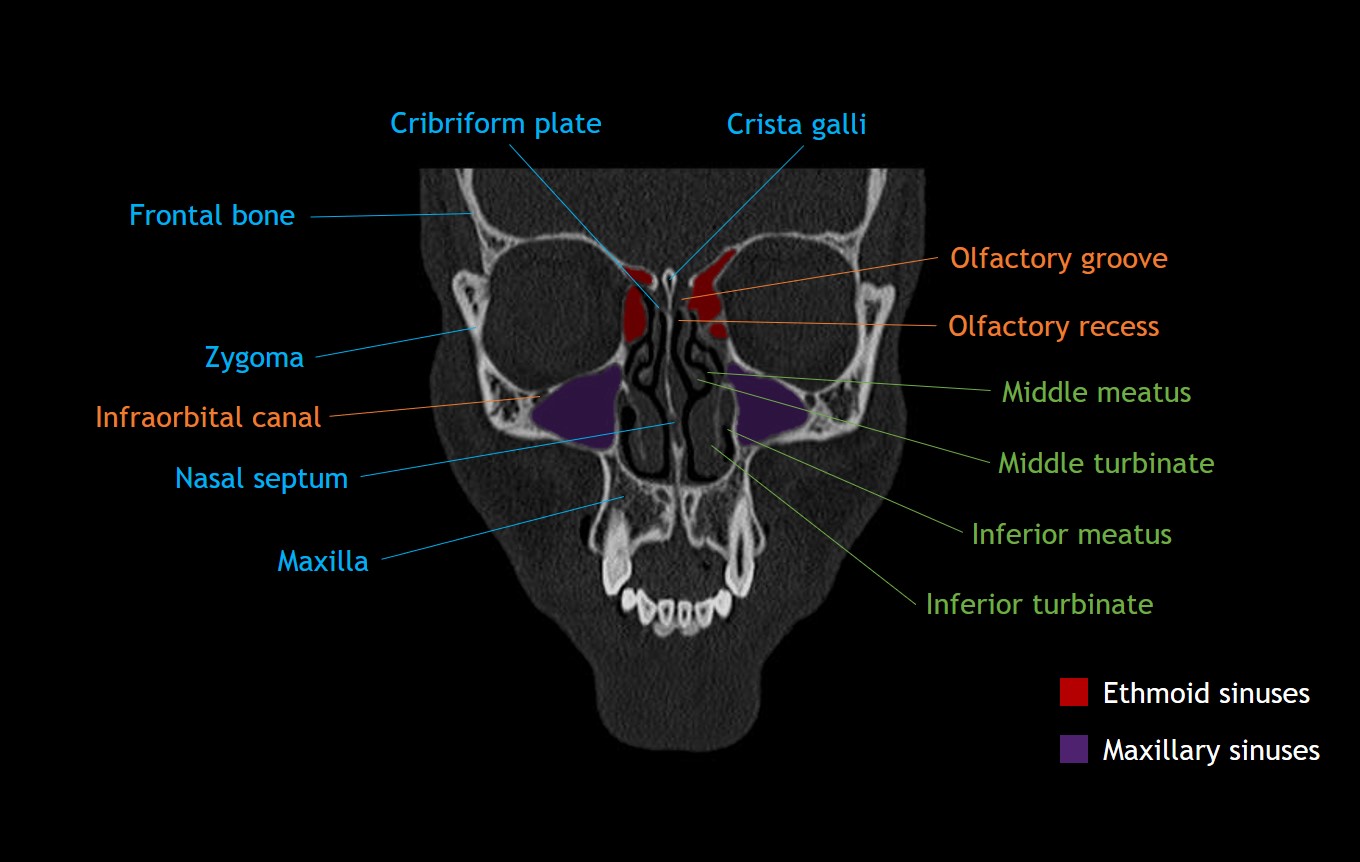 Coronal Face CT Anatomy | CaseStacks.com