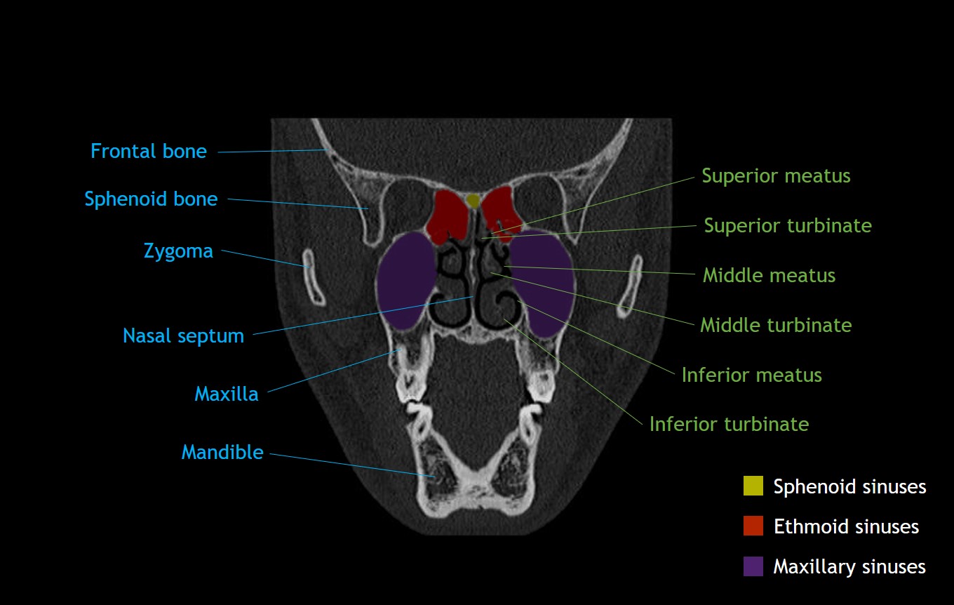 Coronal Face CT Anatomy | CaseStacks.com