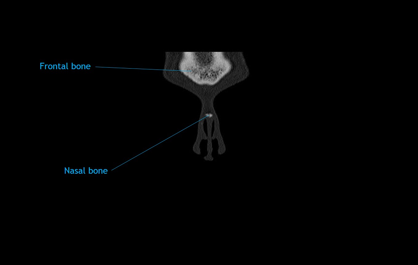 Coronal Face CT Anatomy | CaseStacks.com