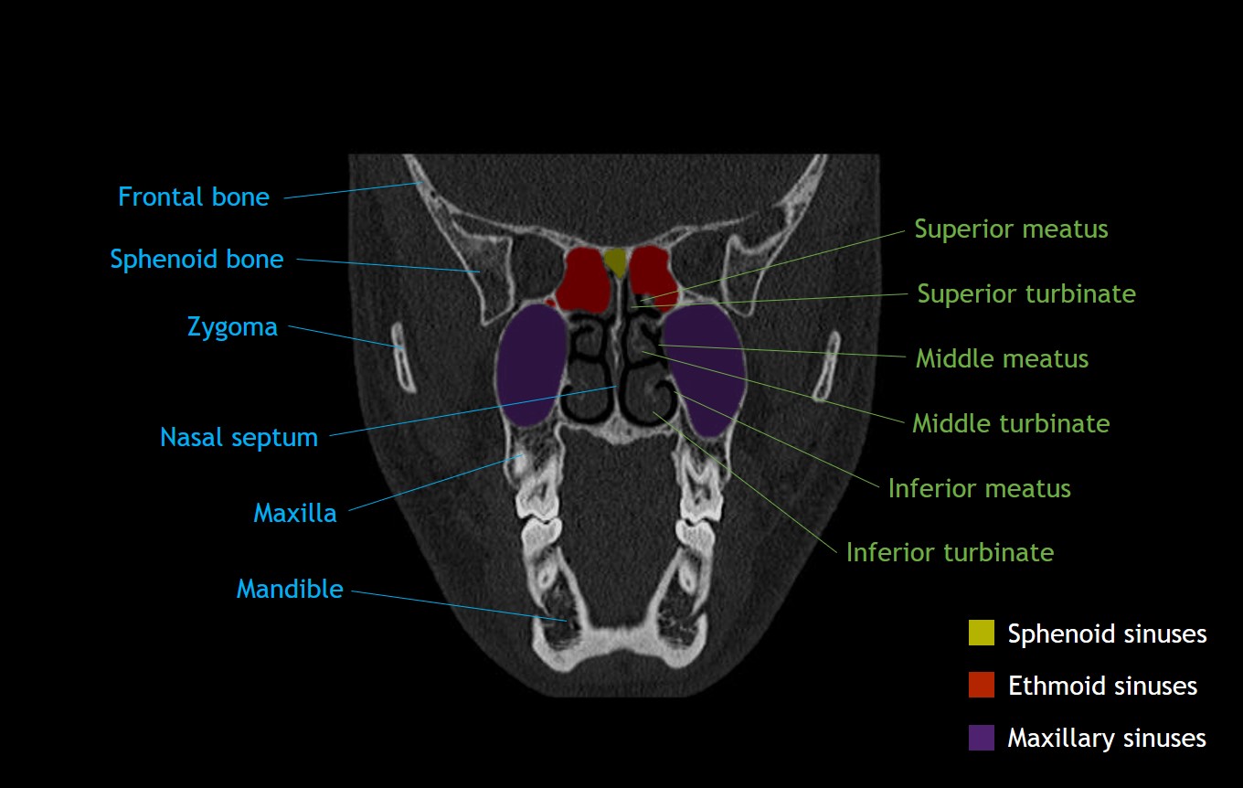 Coronal Face CT Anatomy | CaseStacks.com