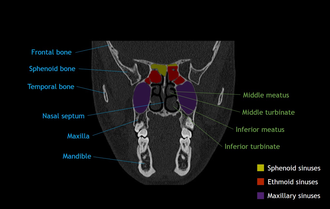 Face Bone Anatomy Ct