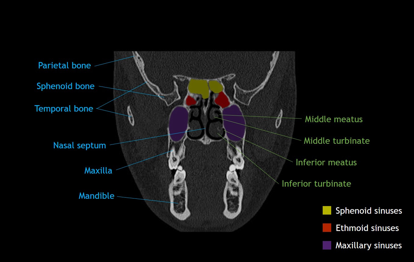 Coronal Face CT Anatomy | CaseStacks.com