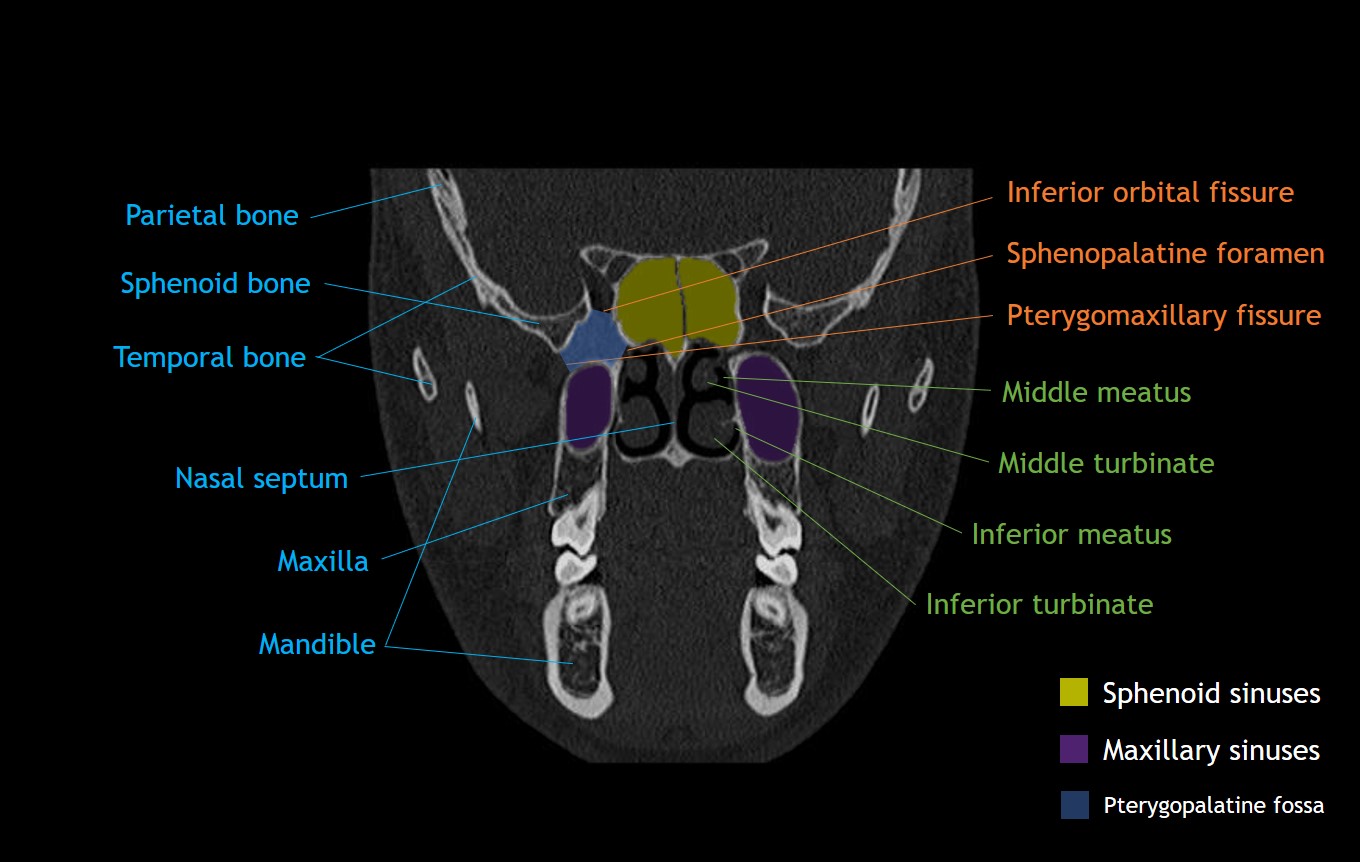 Coronal Face CT Anatomy | CaseStacks.com