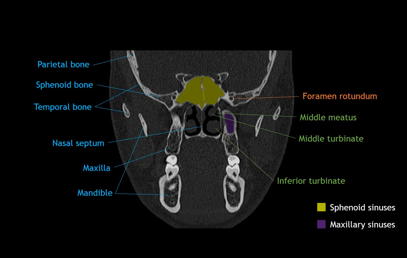 Coronal Face CT Anatomy | CaseStacks.com