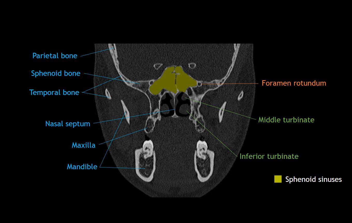 Face Bone Anatomy Ct