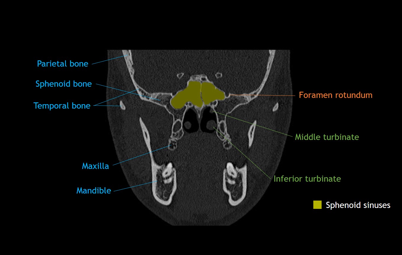 Coronal Face CT Anatomy | CaseStacks.com