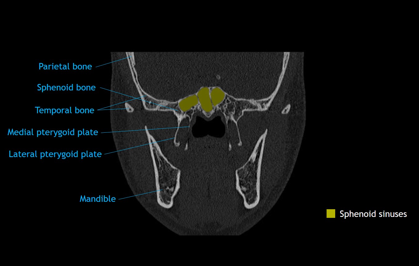 Coronal Face CT Anatomy | CaseStacks.com