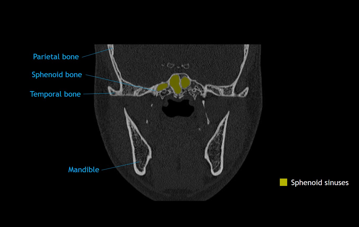 Coronal Face CT Anatomy | CaseStacks.com
