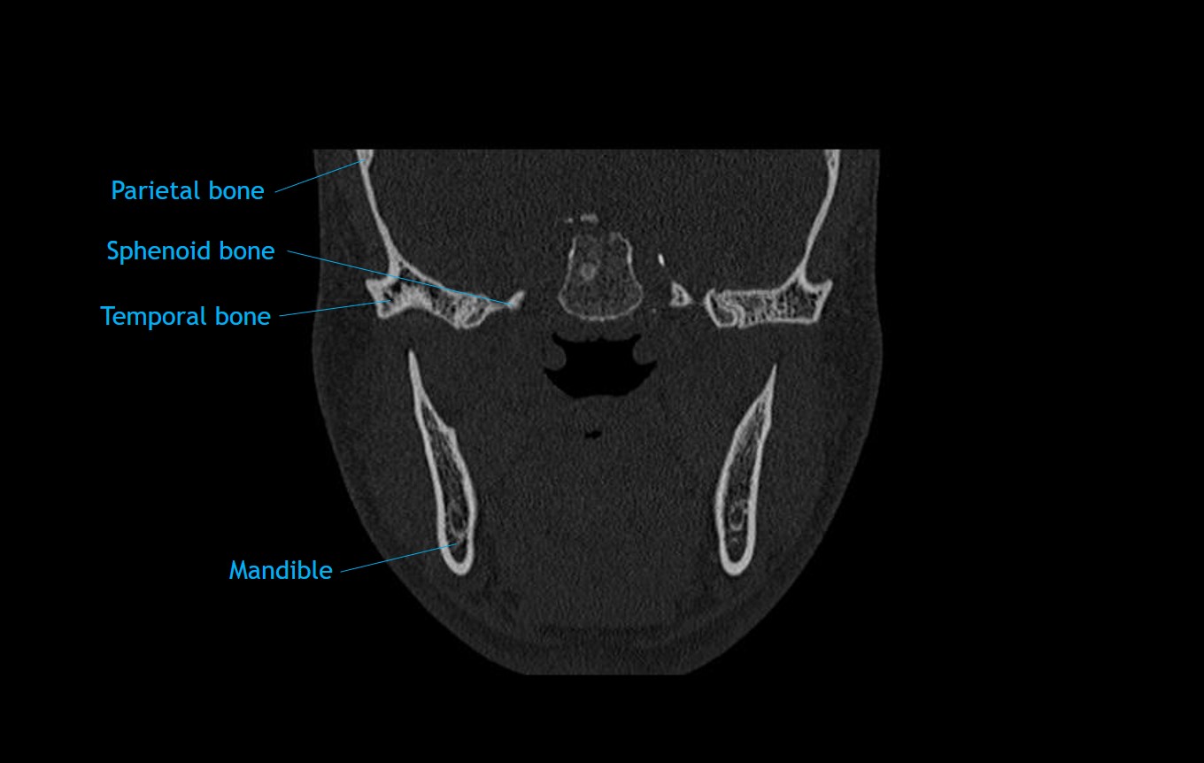 Coronal Face CT Anatomy | CaseStacks.com