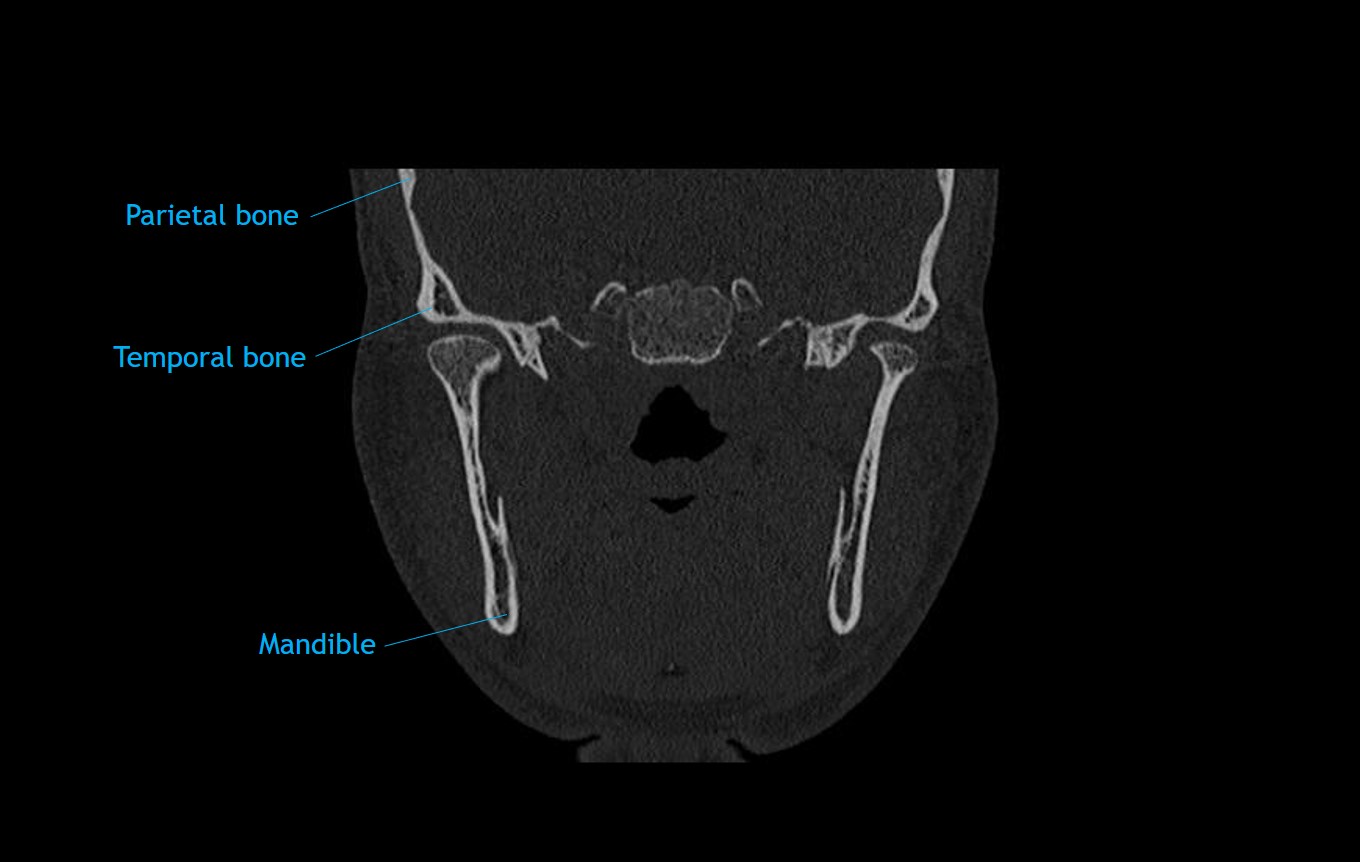 Coronal Face CT Anatomy | CaseStacks.com
