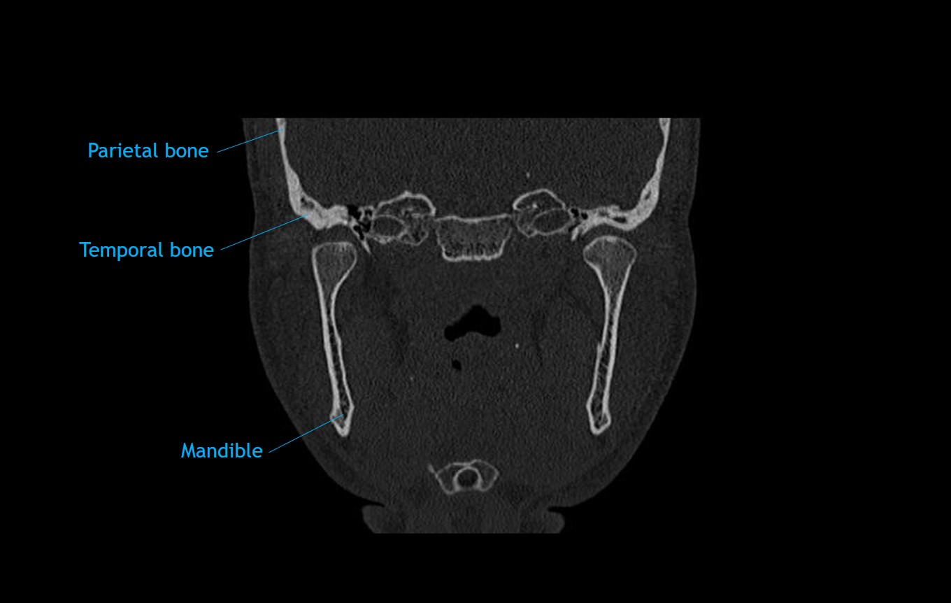 Coronal Face CT Anatomy | CaseStacks.com