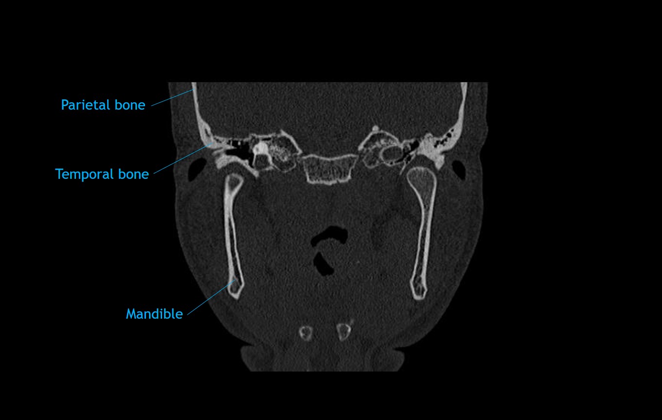 Coronal Face CT Anatomy | CaseStacks.com
