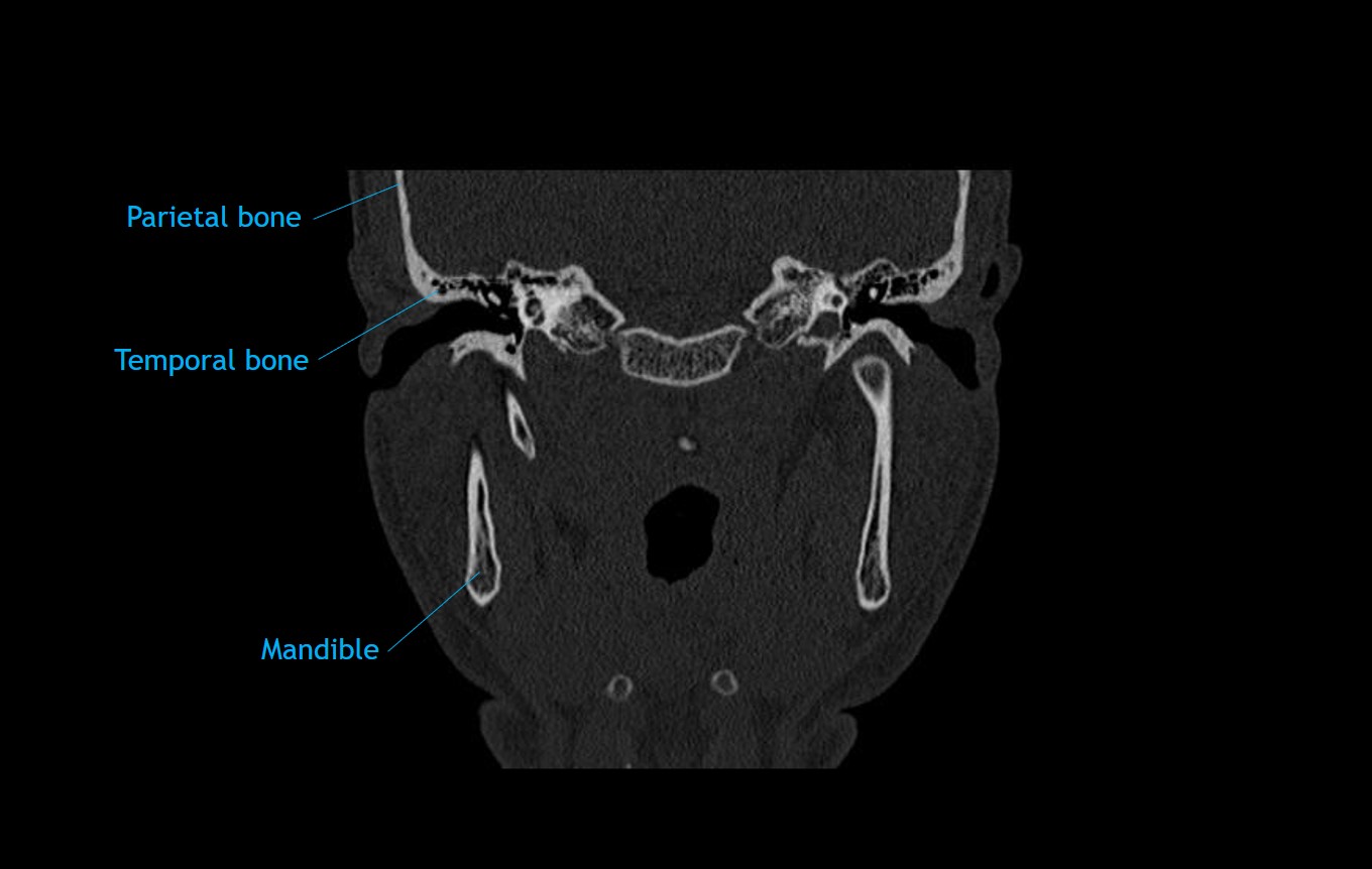 Coronal Face CT Anatomy | CaseStacks.com