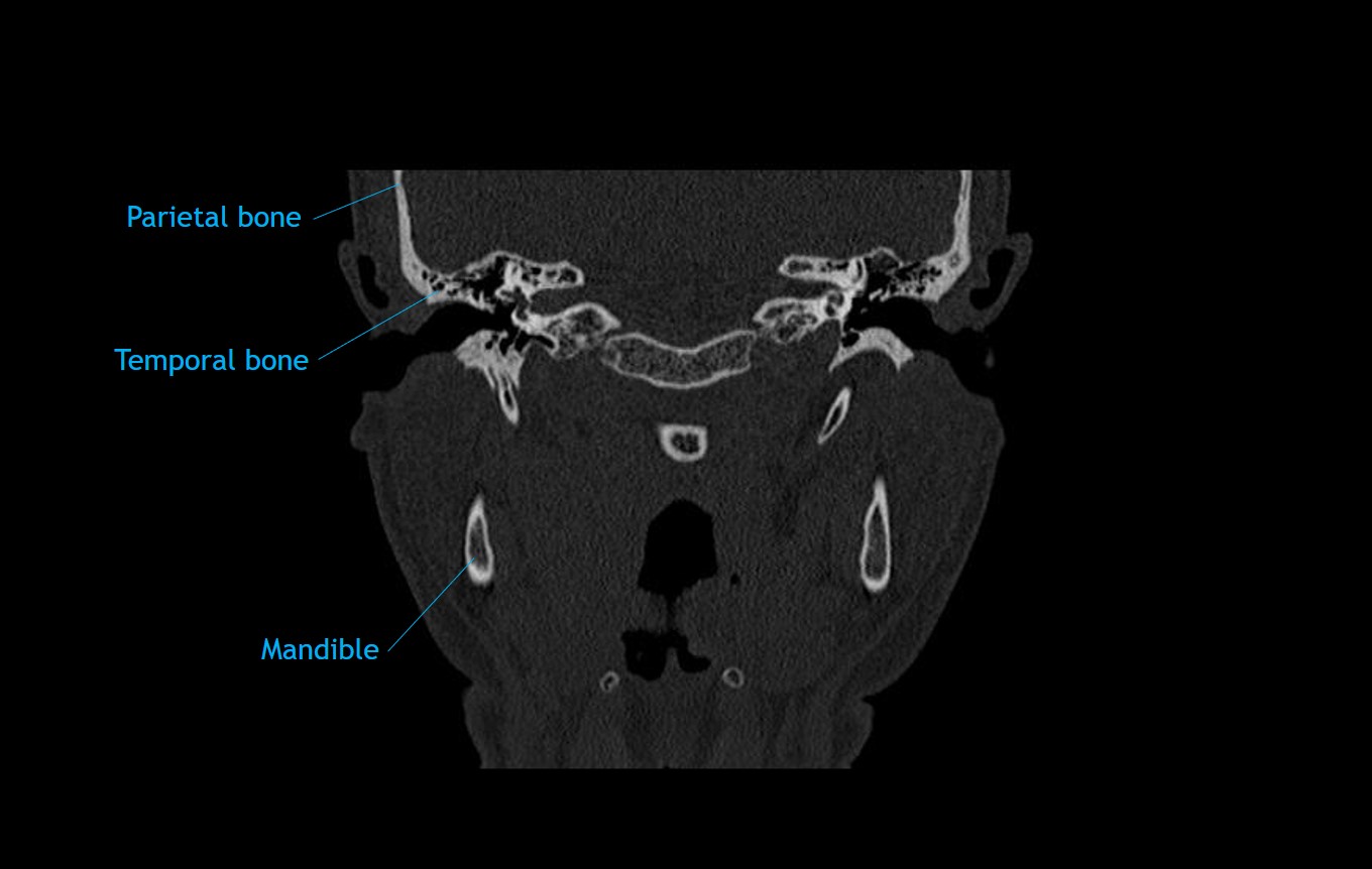 Coronal Face CT Anatomy | CaseStacks.com