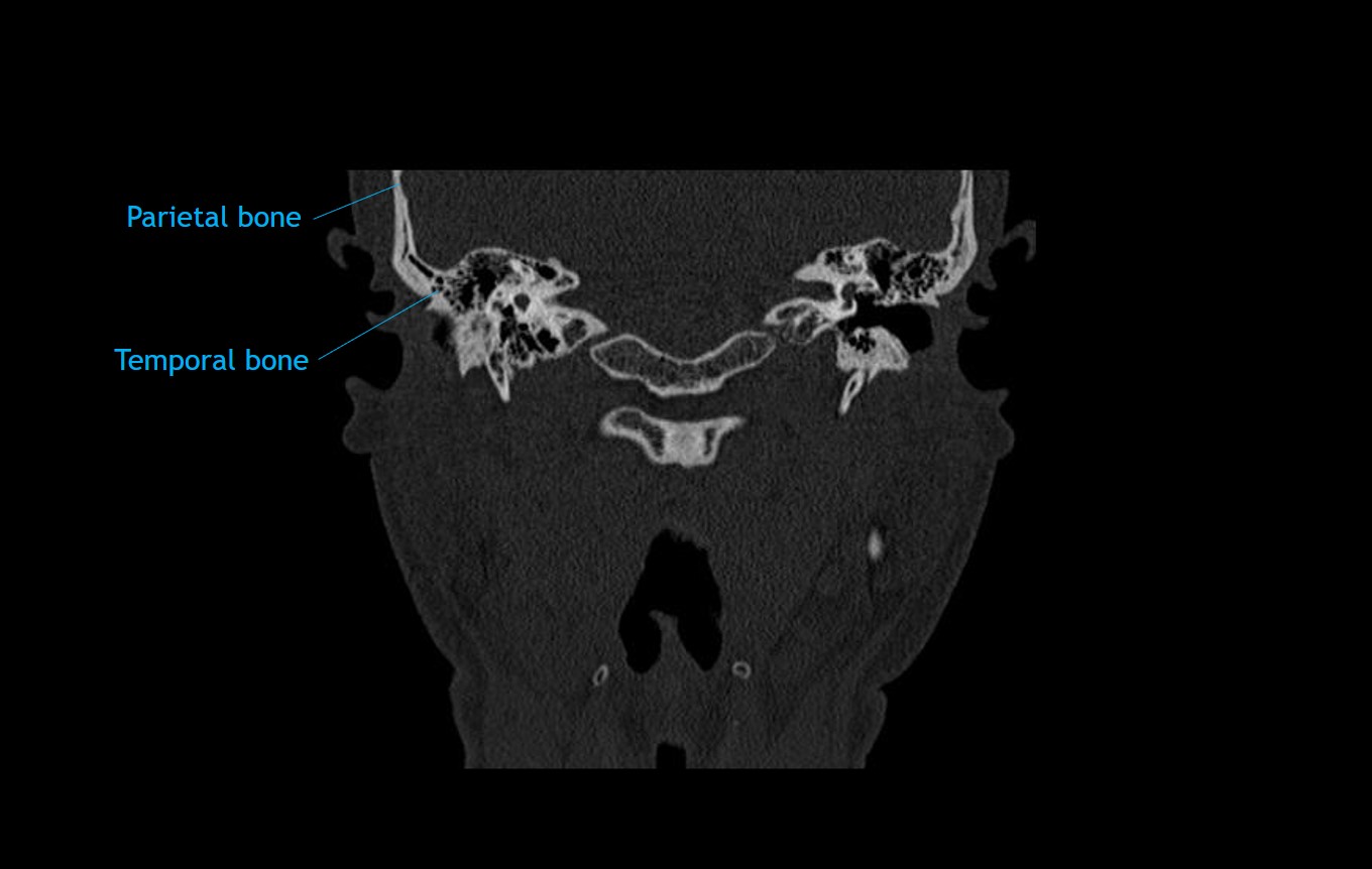 Coronal Face CT Anatomy | CaseStacks.com