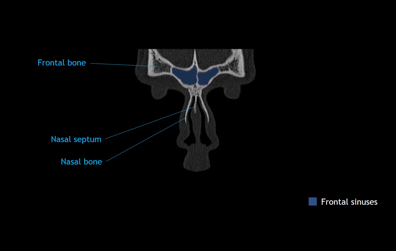 Coronal Face CT Anatomy | CaseStacks.com