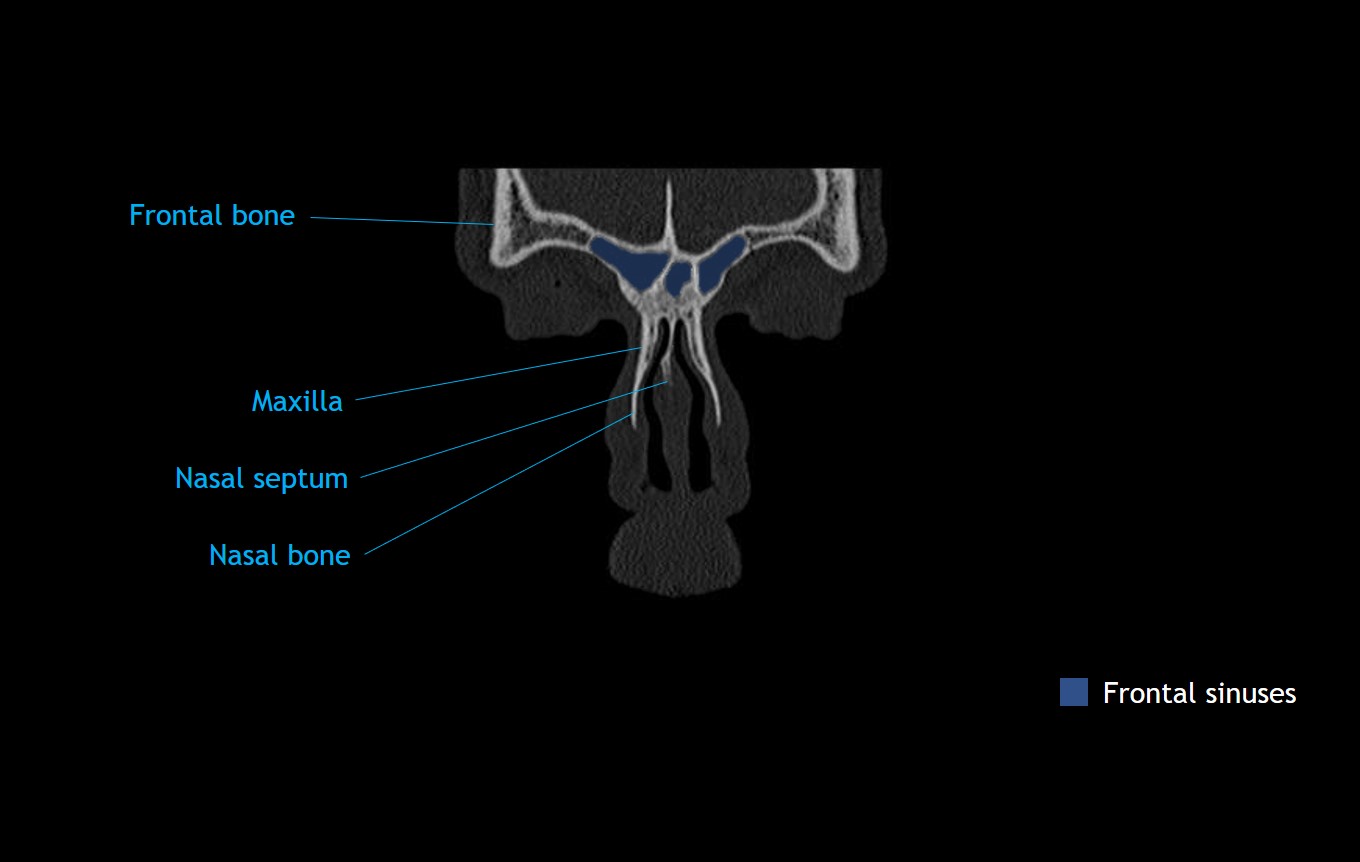 Coronal Face CT Anatomy | CaseStacks.com