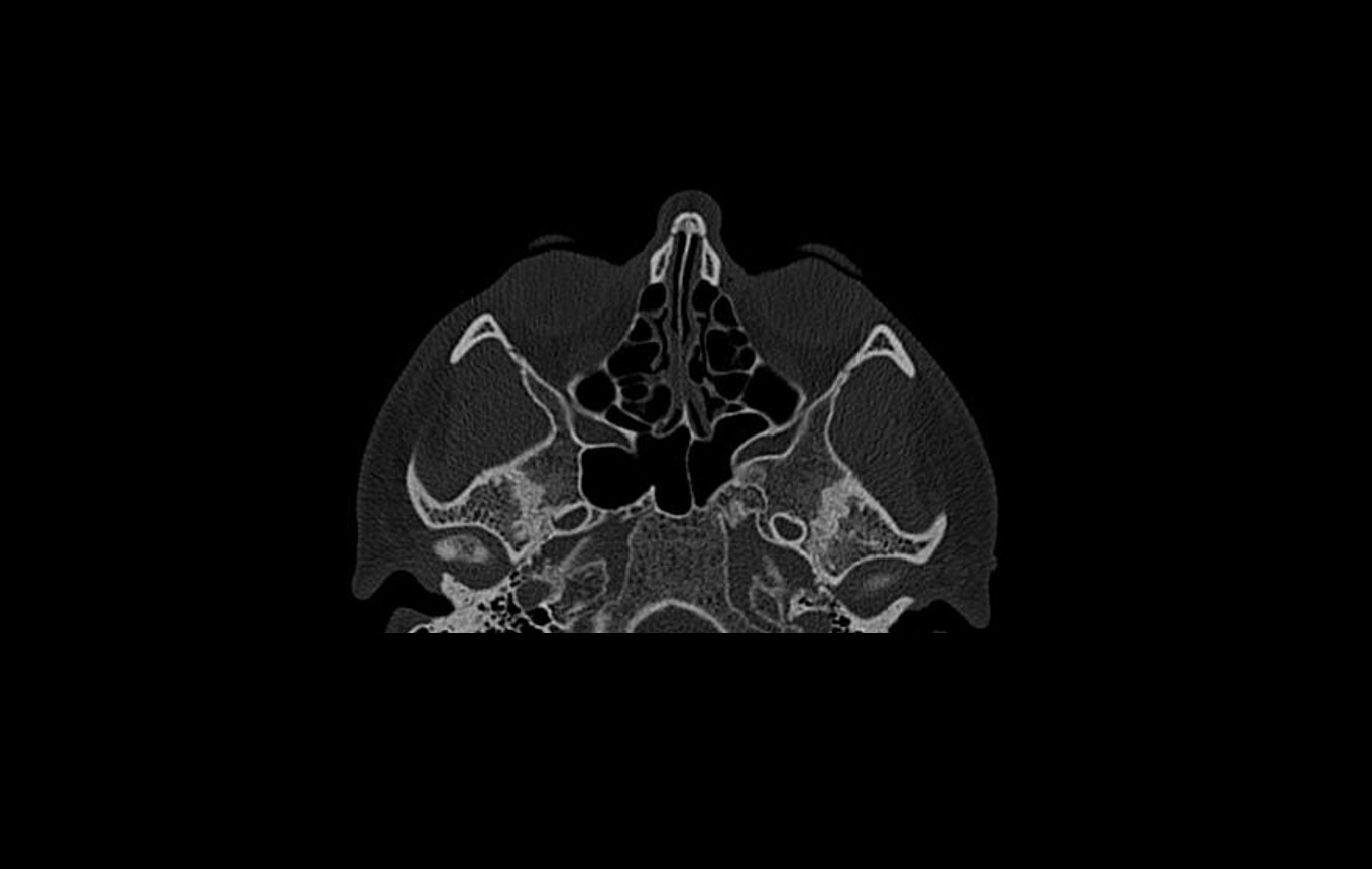 CT Axial Face Anatomy | CaseStacks.com