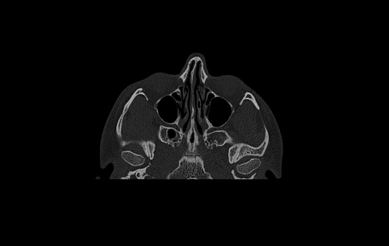 CT Axial Face Anatomy | CaseStacks.com