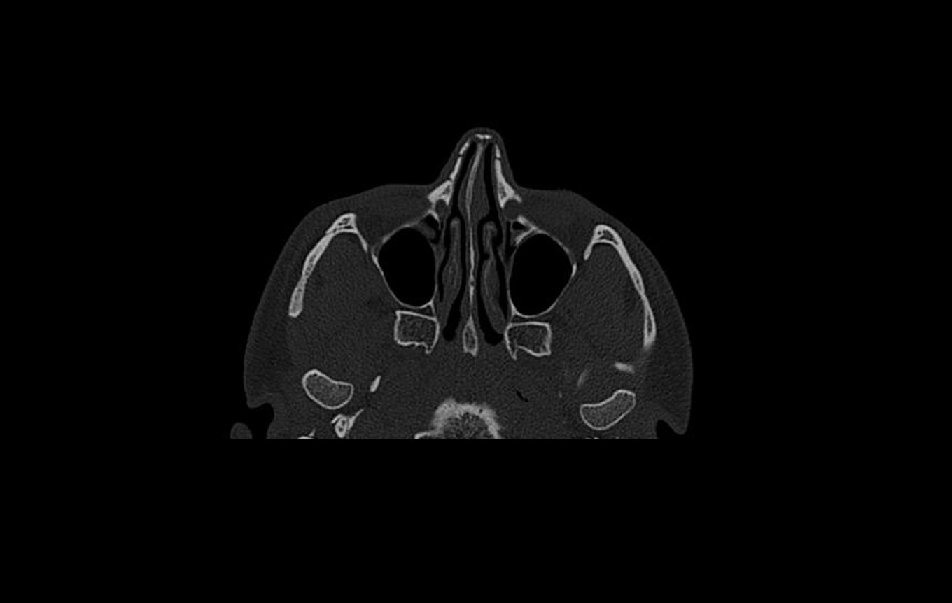 CT Axial Face Anatomy | CaseStacks.com
