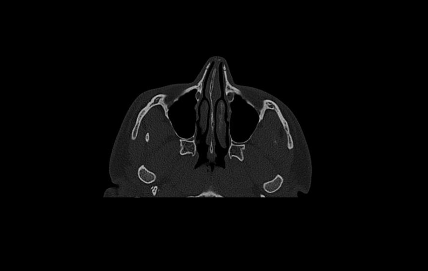 CT Axial Face Anatomy | CaseStacks.com