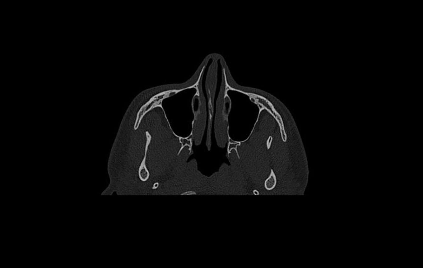 CT Axial Face Anatomy | CaseStacks.com