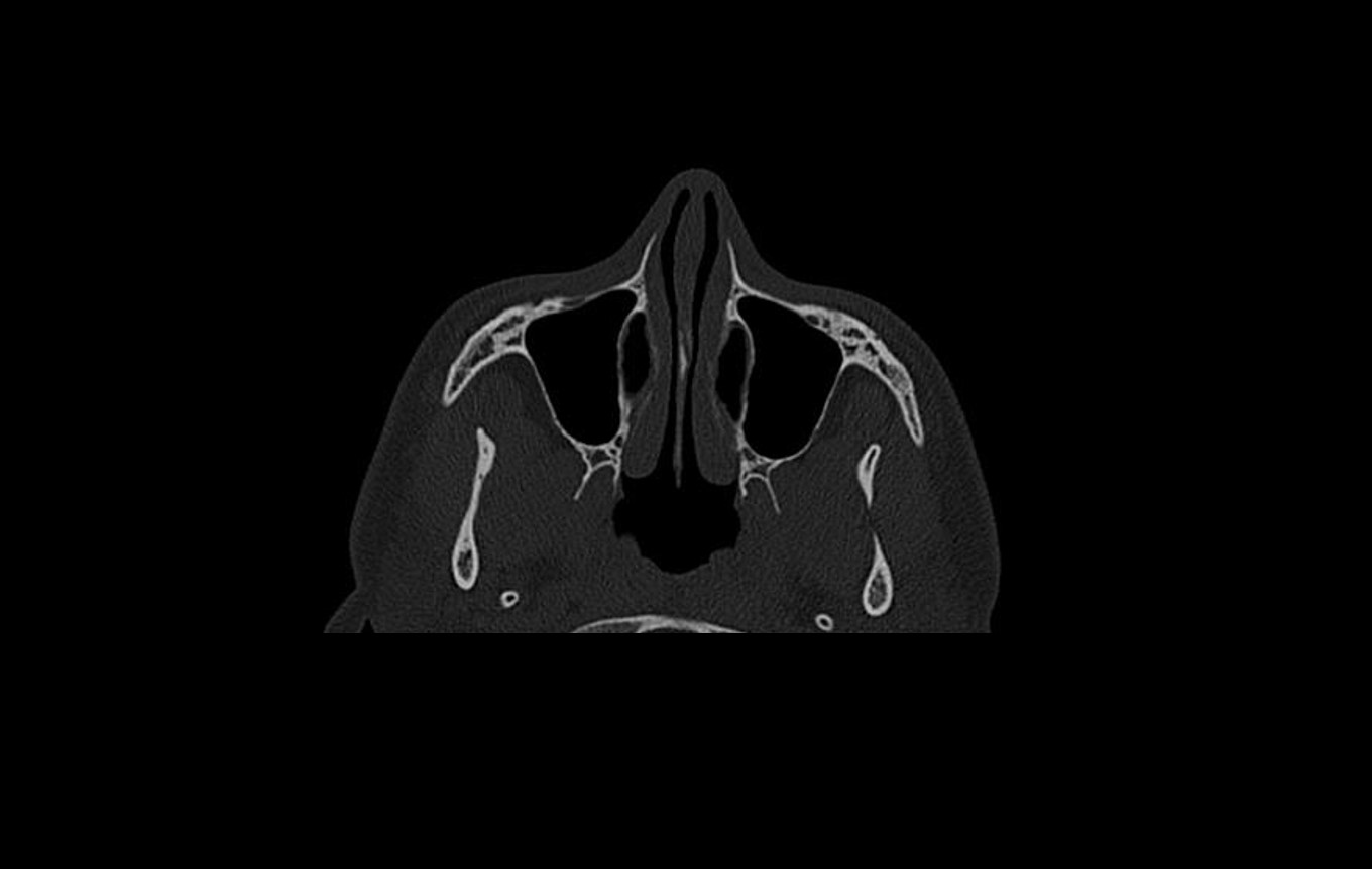 CT Axial Face Anatomy | CaseStacks.com