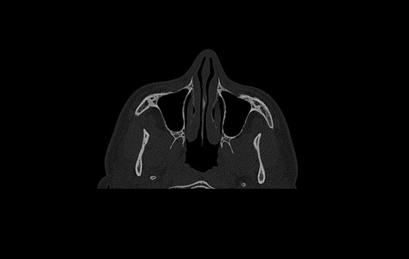 CT Axial Face Anatomy | CaseStacks.com