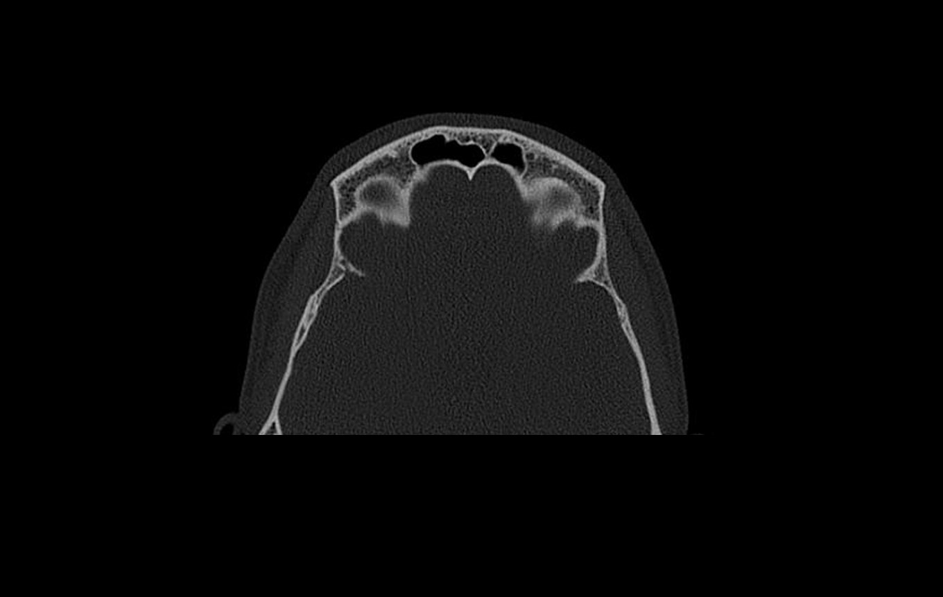 CT Axial Face Anatomy | CaseStacks.com