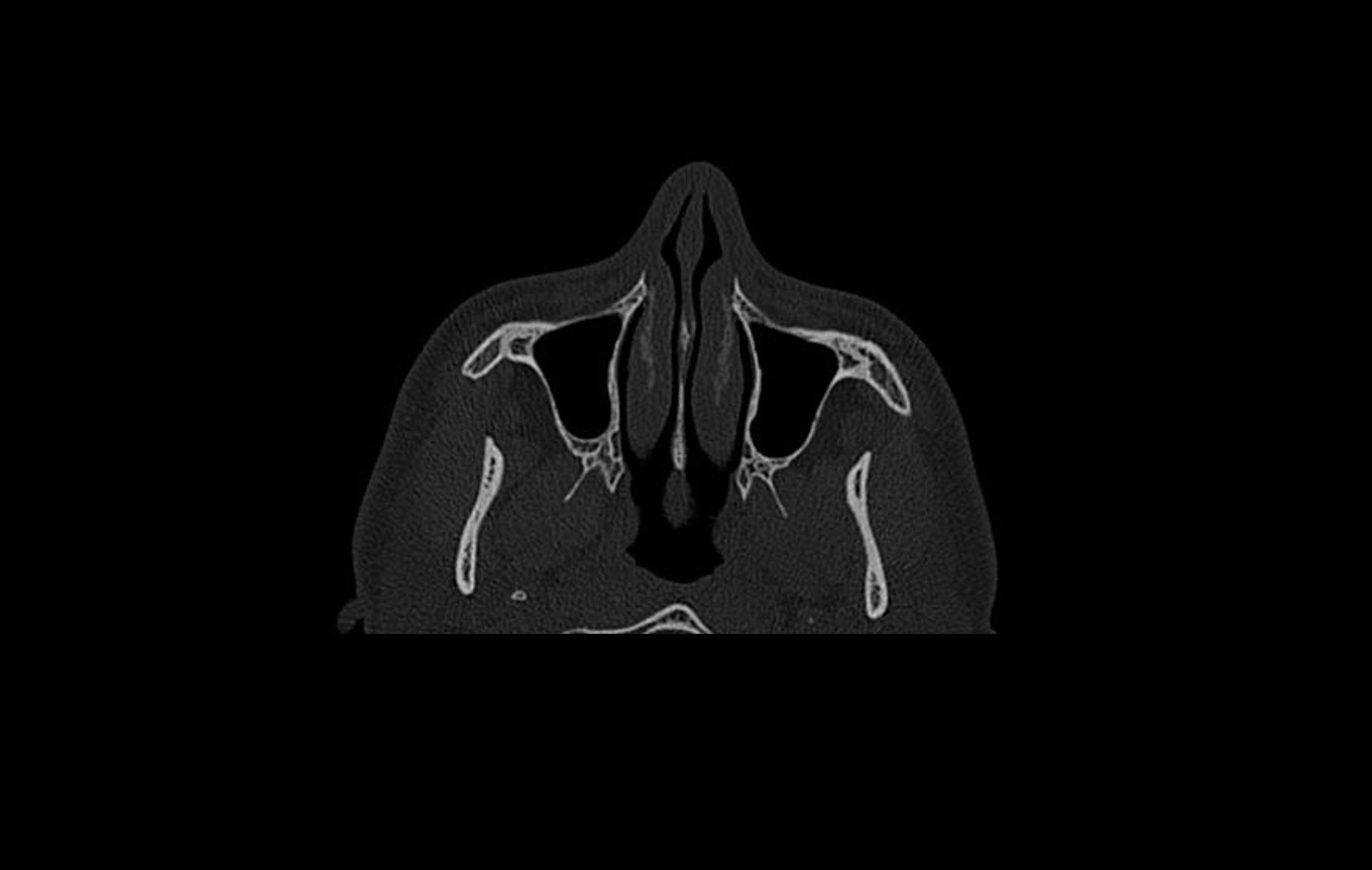 CT Axial Face Anatomy | CaseStacks.com