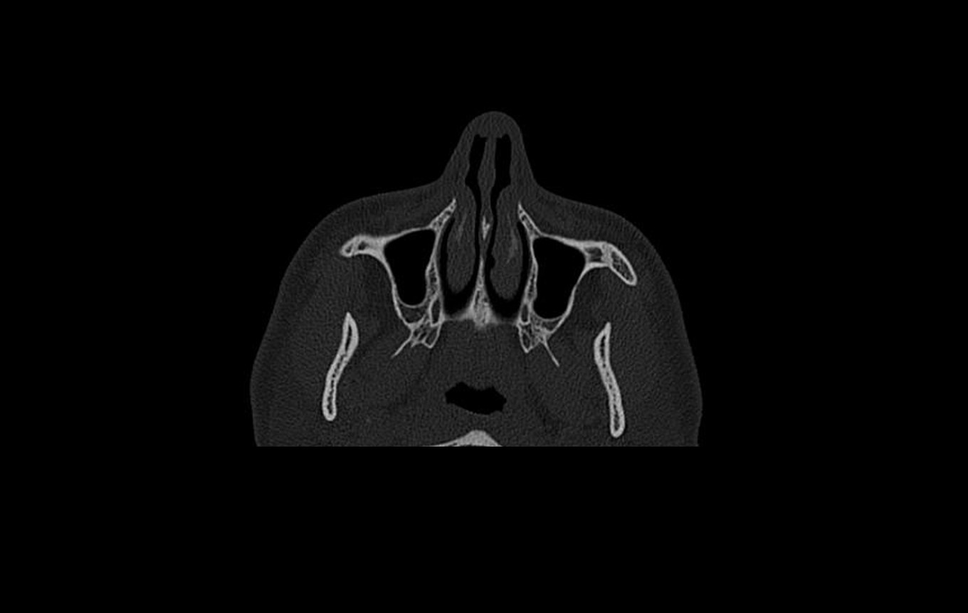 CT Axial Face Anatomy | CaseStacks.com