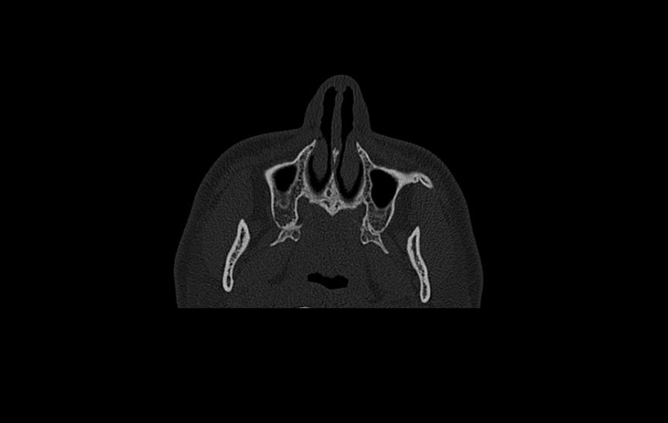 CT Axial Face Anatomy | CaseStacks.com