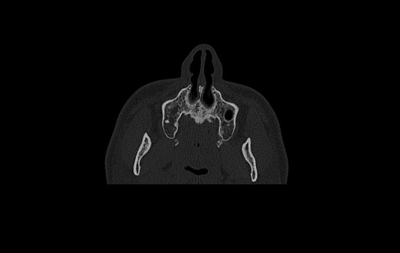 CT Axial Face Anatomy | CaseStacks.com
