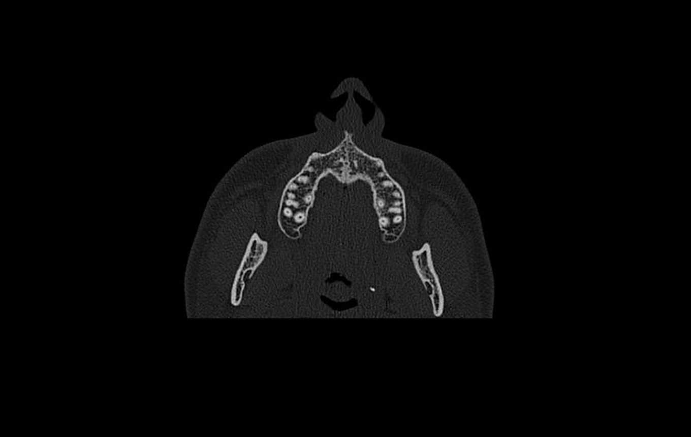 CT Axial Face Anatomy | CaseStacks.com